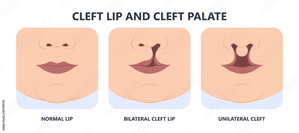 Cleft lip birth defect baby face nose Born gene drink bifid uvula roof ...