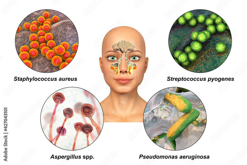 Anatomy of rhinosinusitis and microorganisms that cause sinusitis Stock ...