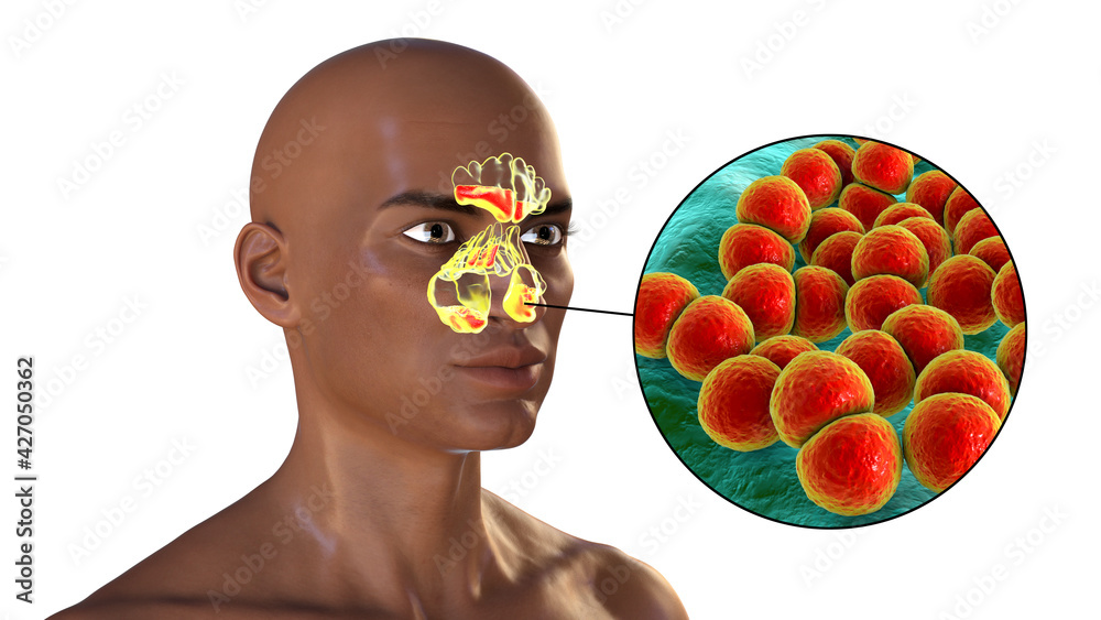 Streptococcus pneumoniae bacteria as a cause of sinusitis Stock ...