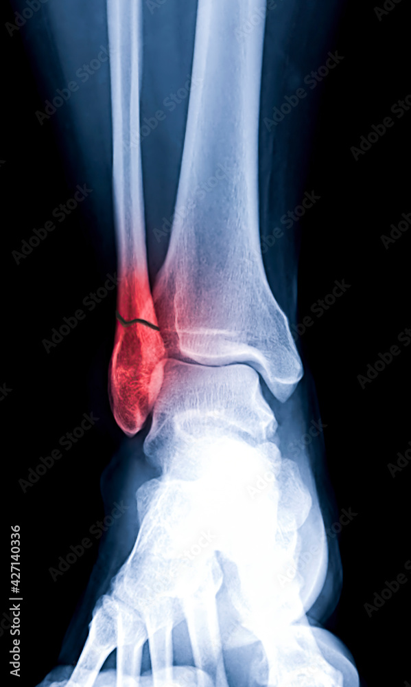 X-ray ankle or Radiographic image or x-ray image of right ankle joint ...