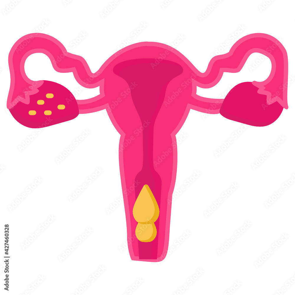 Abnormal Uterine Bleeding Concept, Extremely heavy period Vector Icon ...