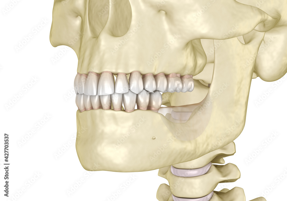 Mandibular Jaw, bone recession after losing molars teeth. Medically ...