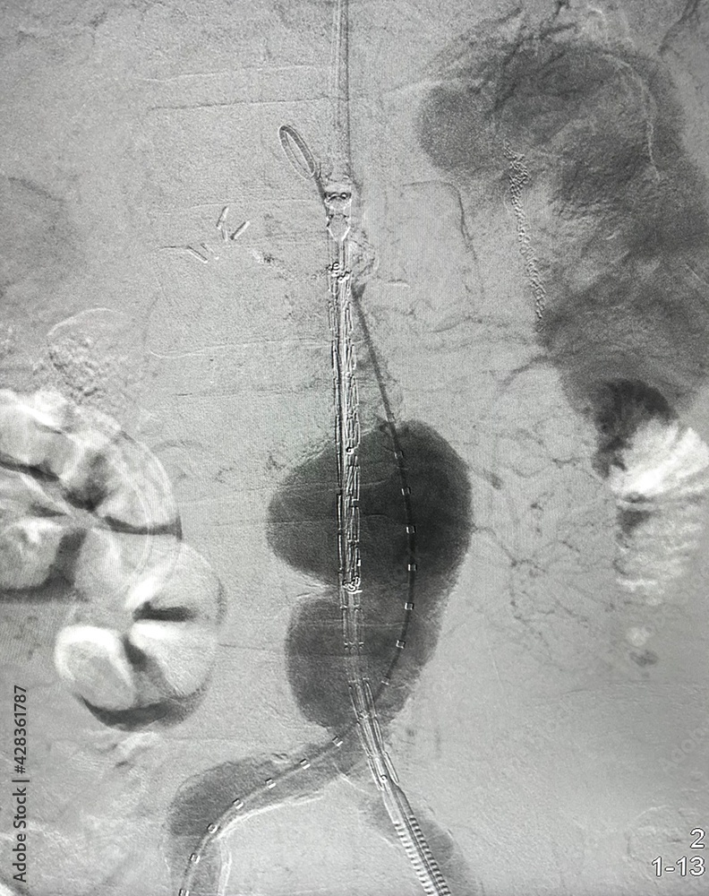 Angiogram of aorta shown Infra-renal abdominal aortic aneurysm (AAA ...