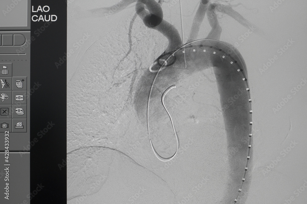 Angiogram of right common iliac artery after aortic stent graft ...