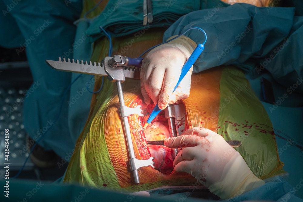 Photo Stock coronary artery bypass graft operation (CABG). Surgery for ...