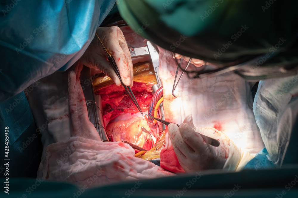 coronary artery bypass graft operation (CABG). Surgery for Coronary ...
