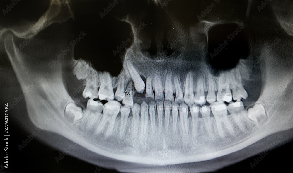 Dental x-ray with braces. Orthopantomography, OPG X-ray DR digital for ...