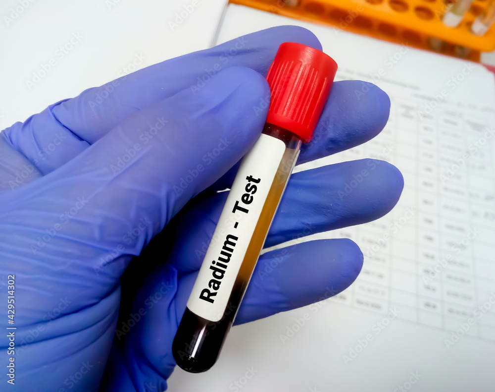 Blood sample for Radium (heavy metal) test, toxic metal. Diagnosis of ...