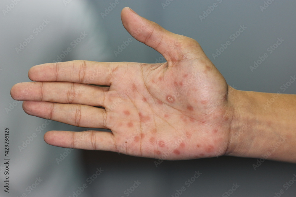 Foto de Stock Secondary stage syphilis sores (lesions) on the palms of ...