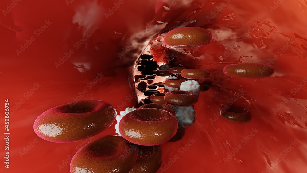 Hemostasis. Red blood cells and platelets in the blood vessel. Basic ...