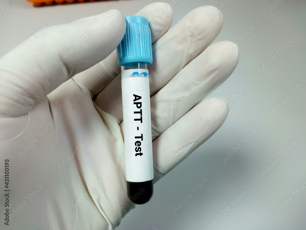 Blood Sample for Activated Partial Thromboplastin Time (APTT). Blood ...