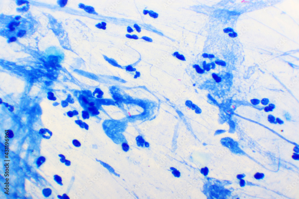 Foto Mycobacterium tuberculosis positive (small red rod) in sputum ...