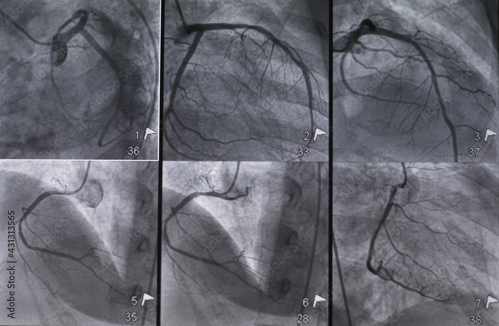 Coronary angiogram (CAG) was performed left and right coronary artery ...