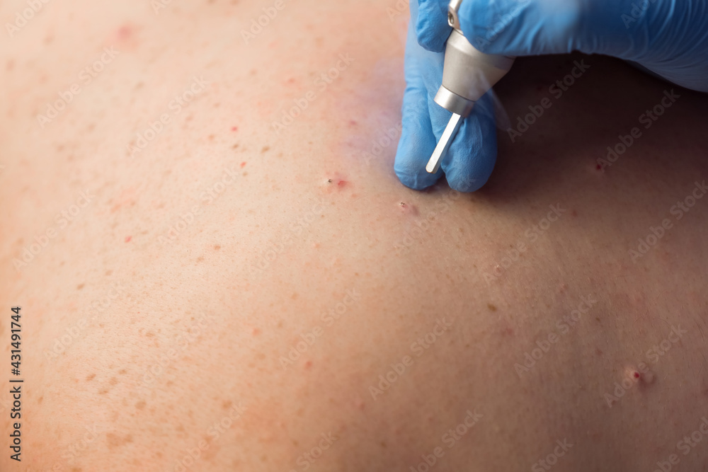 Surgeon is removing many moles using laser on man's back, body, burning ...