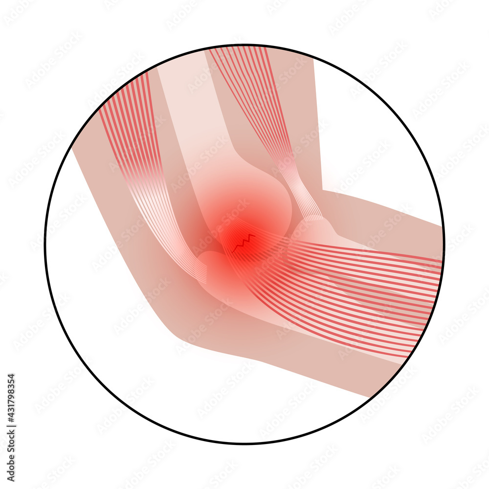 Medial epicondylitis golfer elbow Stock Vector | Adobe Stock