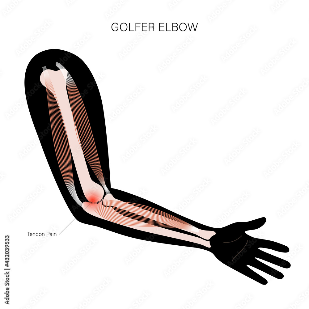 Medial epicondylitis golfer elbow Stock Vector | Adobe Stock