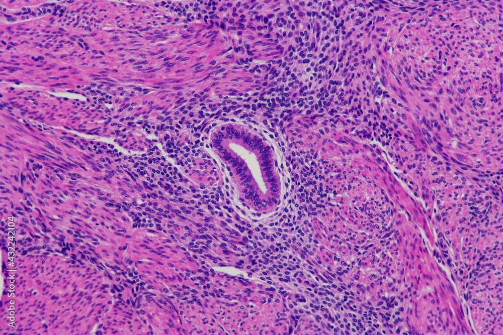 Endometrial gland and stroma surrounded by muscle in a painful ...