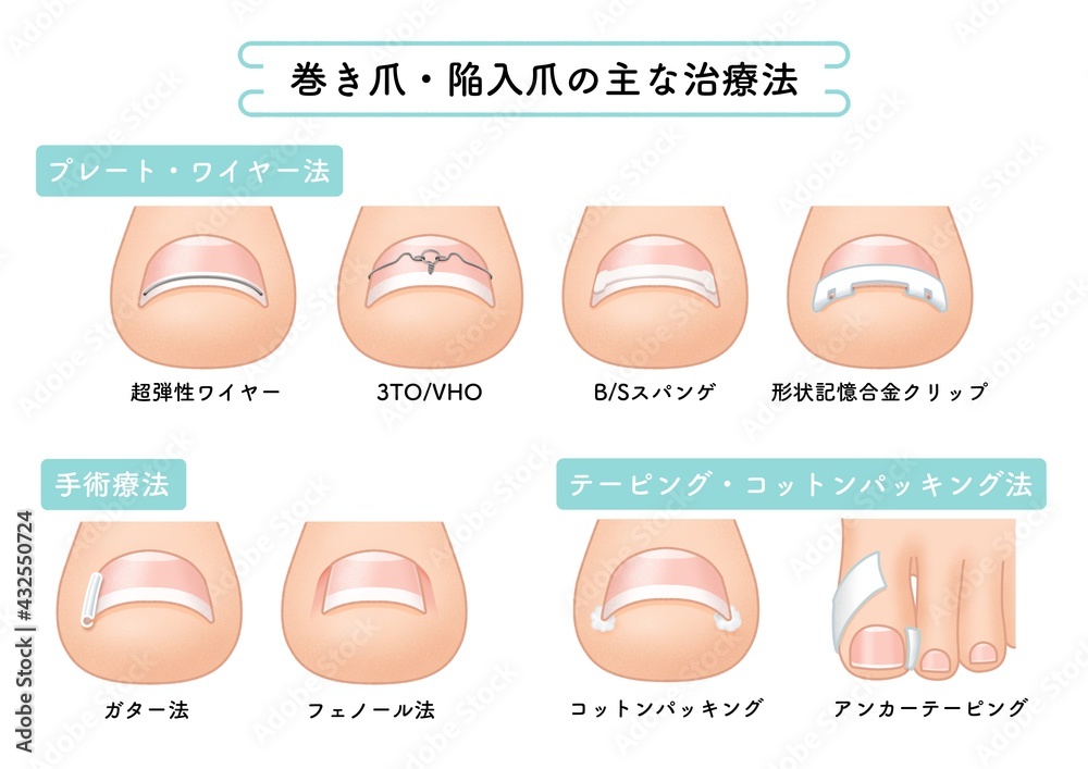 Стокова ілюстрація 巻き爪 陥入爪 治療法 イラスト 一覧 | Adobe Stock