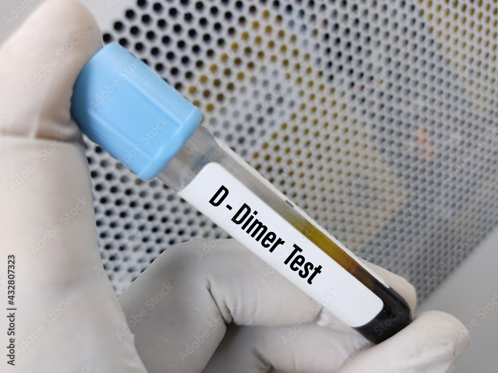 D-Dimer test. Corona patient monitoring test in ICU. Doctor or ...