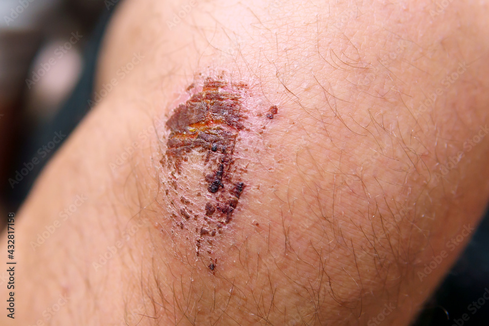 wound, a dried up crust change to scar on the skin. selective focus ...