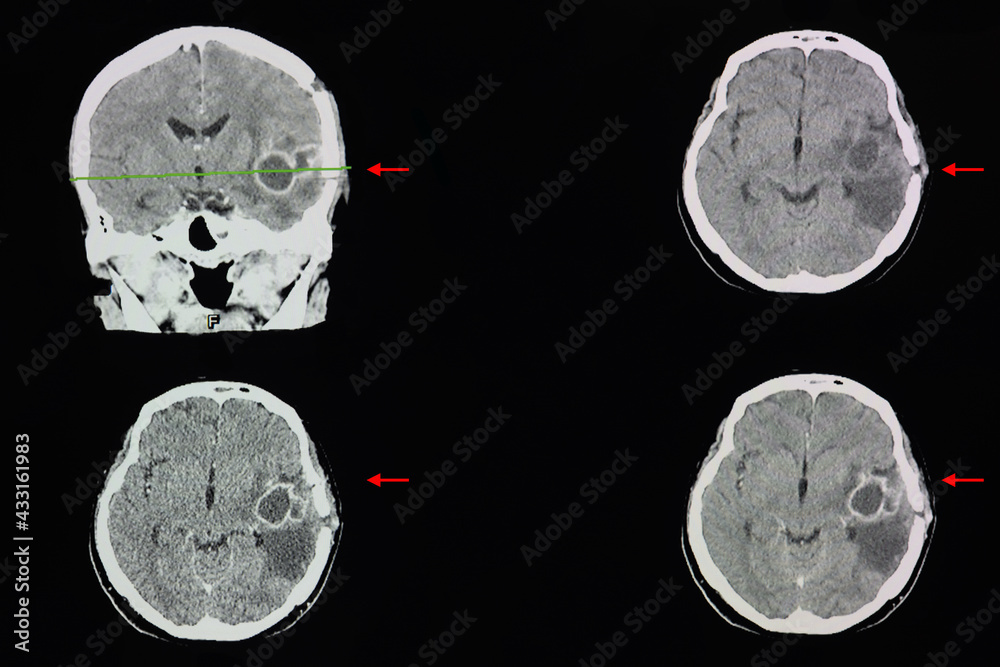 CT brain scan of a patient with brain abscess. Stock Photo | Adobe Stock