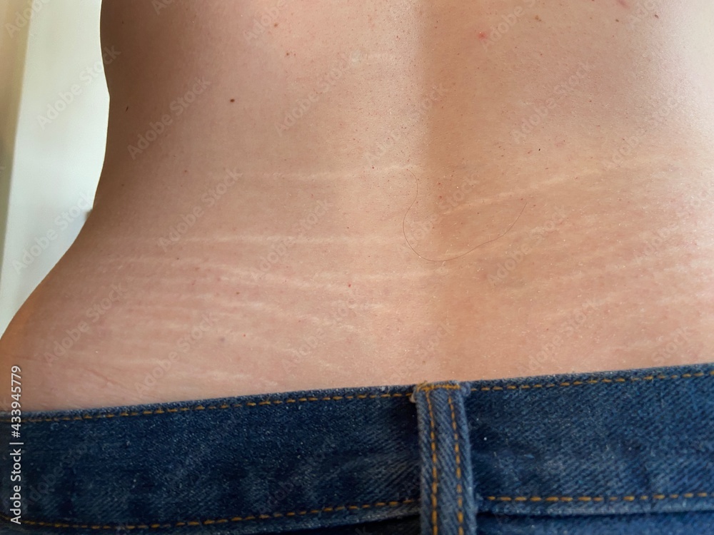 stretch marks on womans back at waistline stretch marks going horizontal across back Stock Photo Adobe Stock