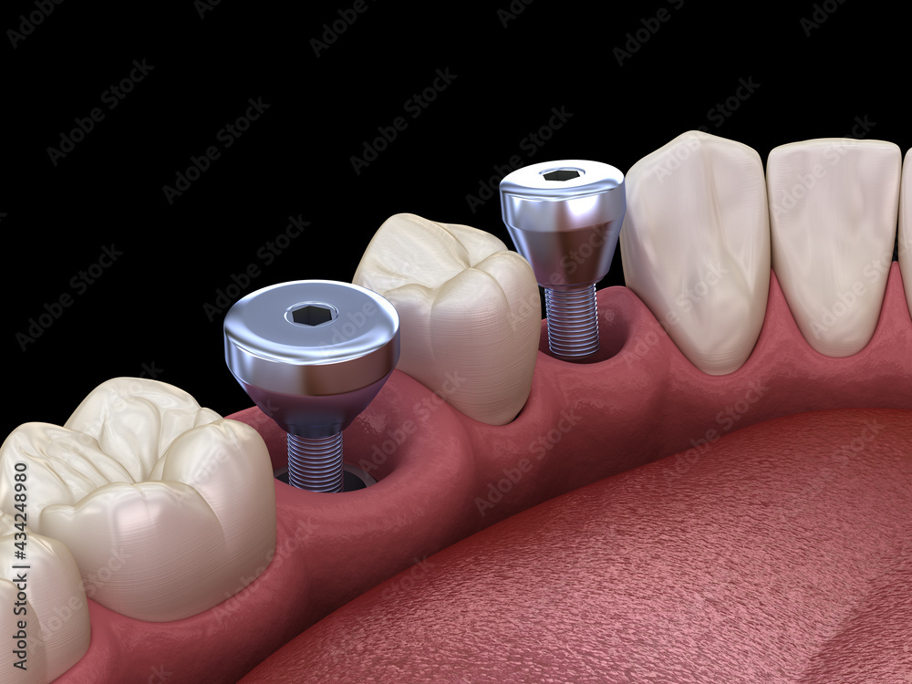 Cover screw - temporary implant abutment. Medically accurate 3D ...