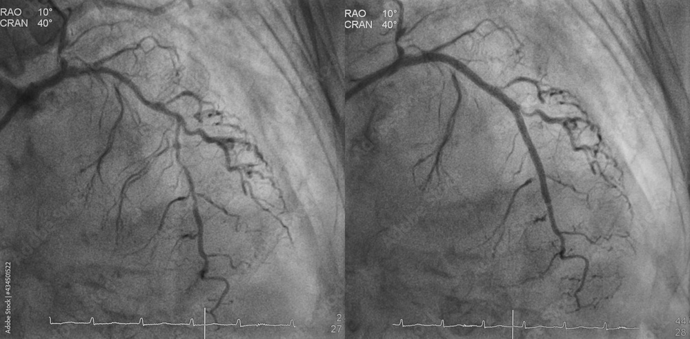 Comparison of pre-post percutaneous coronary intervention (PCI) at ...