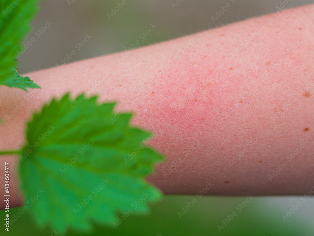 Hand with dermatitis red itchy swollen skin after touching nettle ...