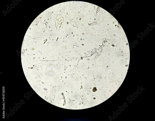 Yeast Infection; Budding yeast and pseudohyphae of Candida albicans ...