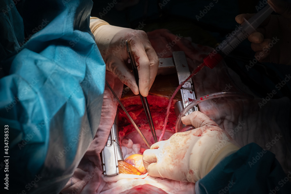 Foto de Stock coronary artery bypass graft operation (CABG). Surgery for Coronary Artery Bypass ...