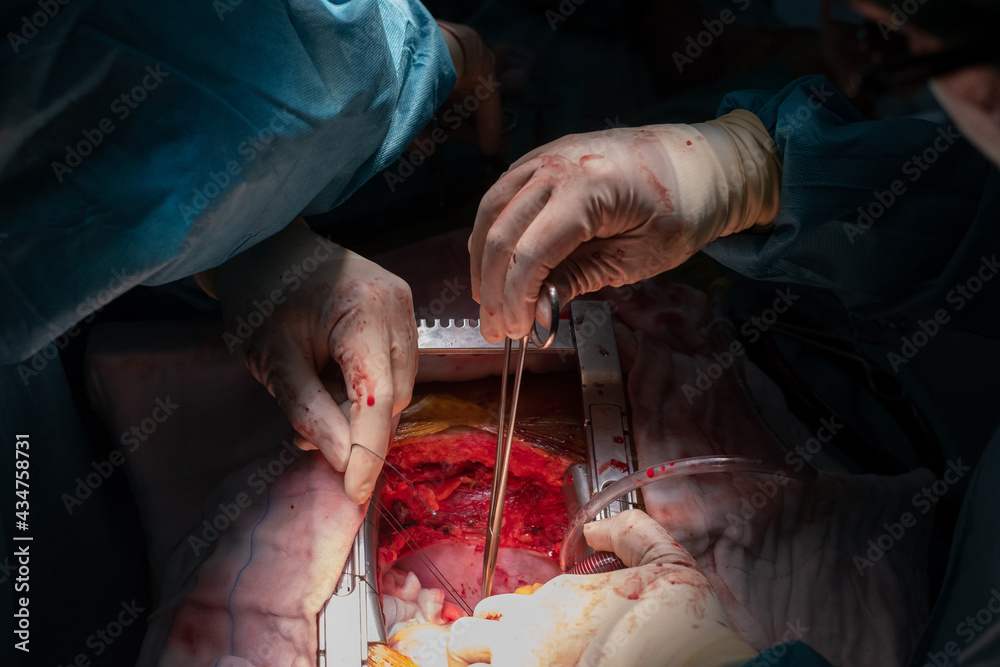 coronary artery bypass graft operation (CABG). Surgery for Coronary Artery Bypass Grafting: CABG ...