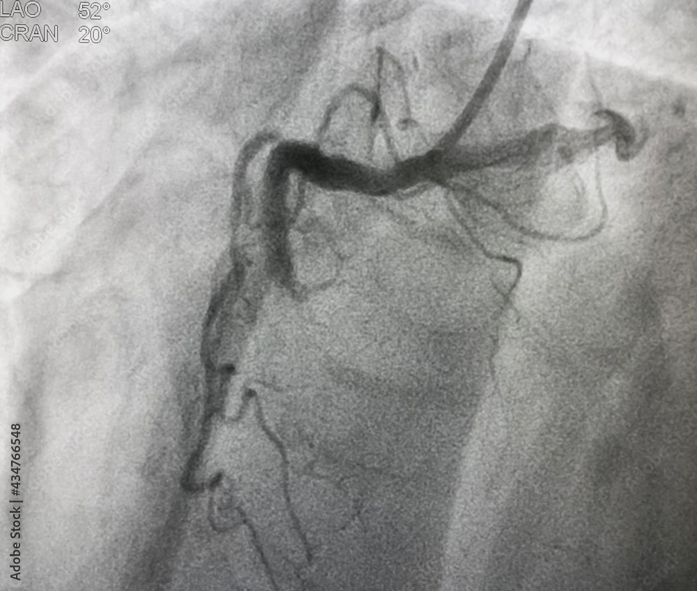 coronary angiogram shown massive thrombus that occluded right coronary ...