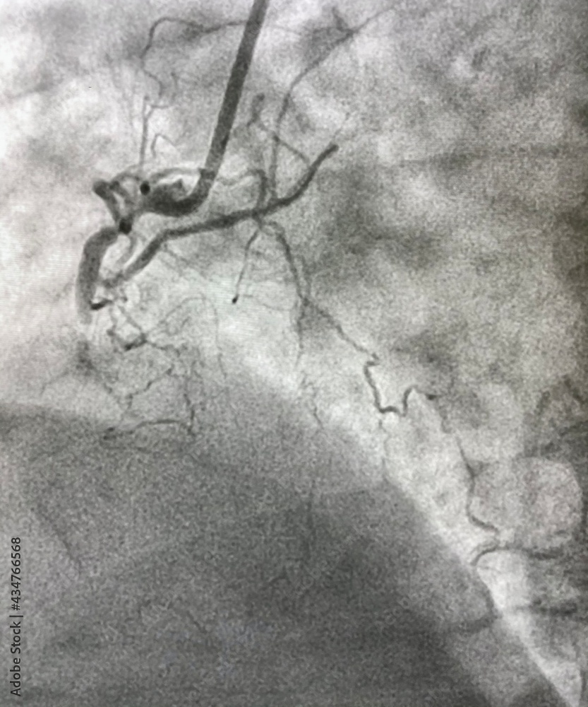 coronary angiogram shown massive thrombus that occluded right coronary ...