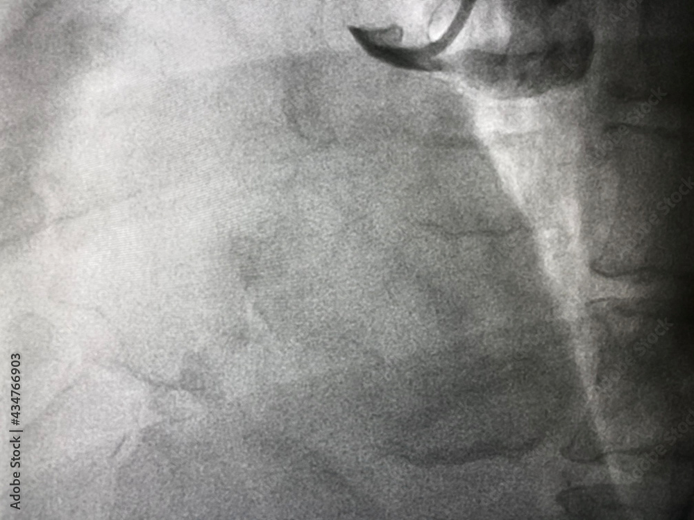 coronary angiogram shown massive thrombus that occluded right coronary ...
