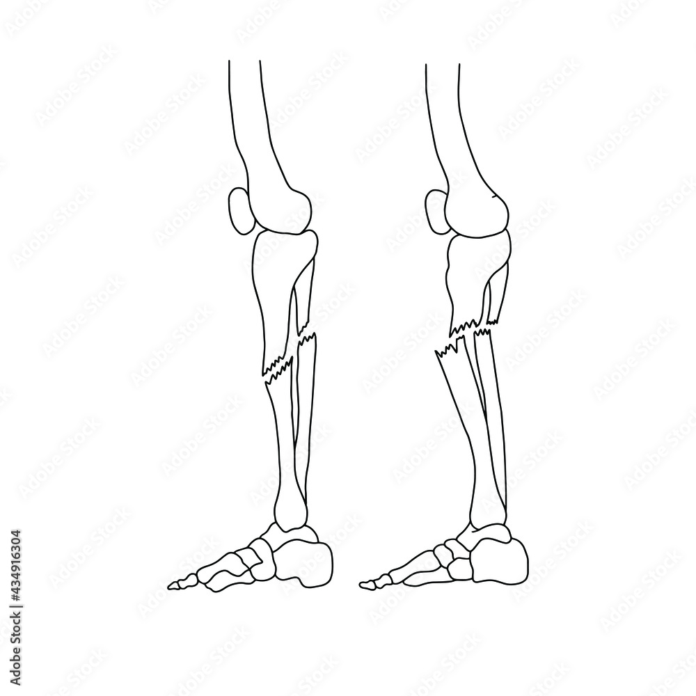 Human Leg fracture: closed and open. Types of bone fractures. Stock ...