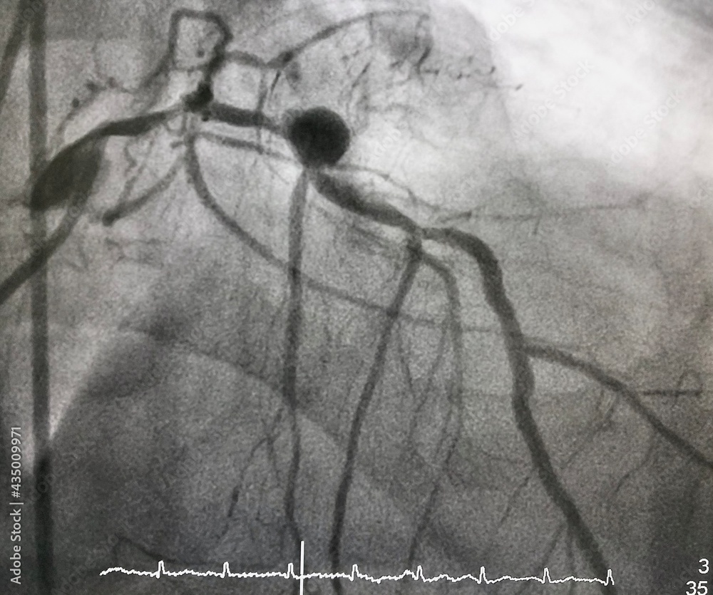 Coronary angiogram shown left anterior descending artery (LAD) stenosis ...