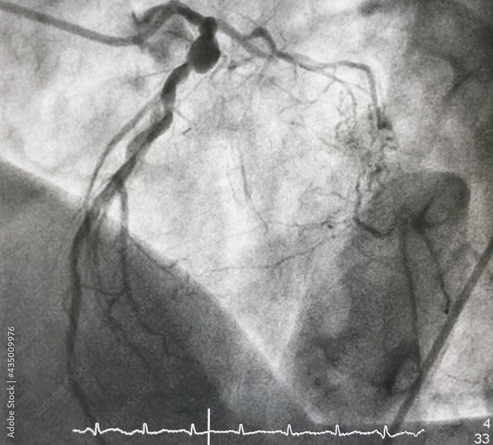 Photo Stock Coronary angiogram shown left anterior descending artery ...