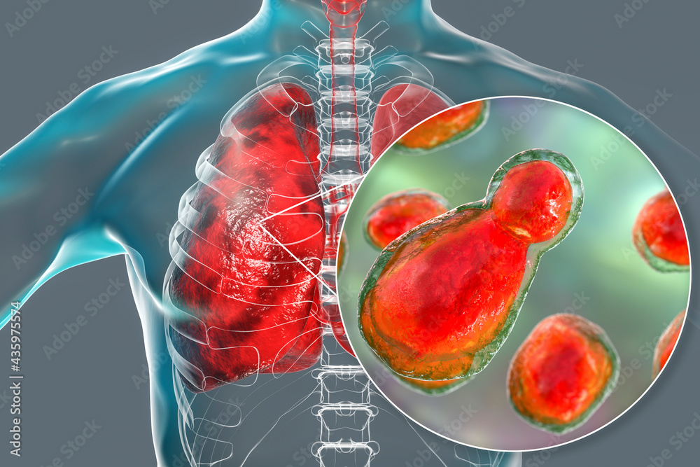Pulmonary cryptococcosis, invasion of a lung tissue by yeast fungi ...