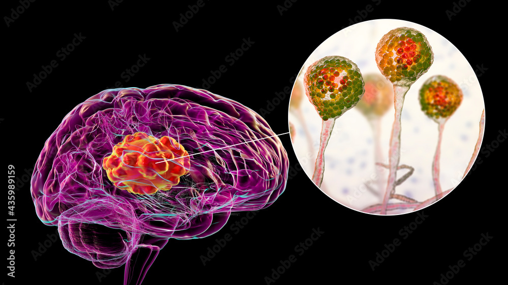 Brain mucormycosis, a brain lesion caused by fungi Mucor, also known as ...