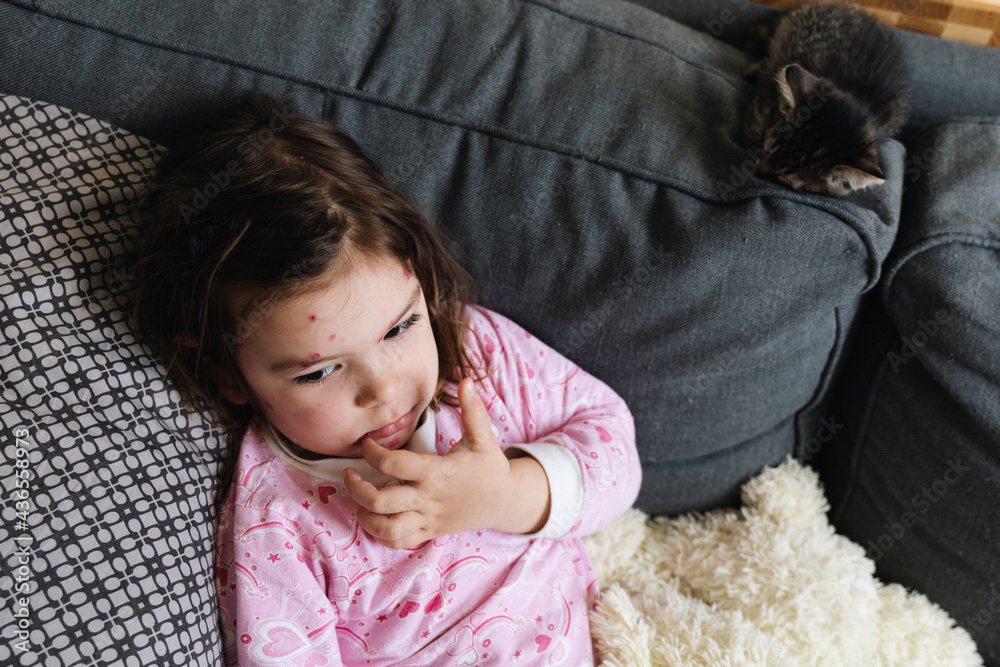 Toddler girl with chickenpox measles on the body. Varicella virus ...
