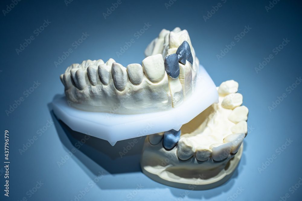 Plaster model of human teeth close up. Models of teeth and jaws as a ...