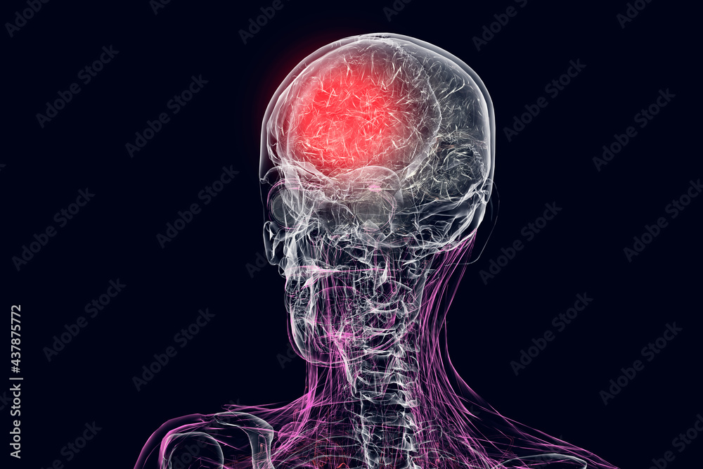 Computed tomography detects brain dysfunctions and the source of the ...