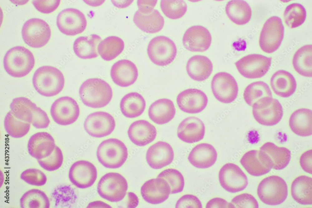 Target cells with abnormal red blood cells in blood smear, specimen ...