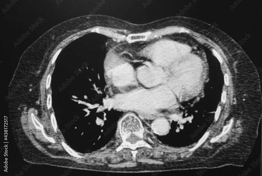 Foto de Stock CT Abdomen Cross section View. CT scan (computed ...