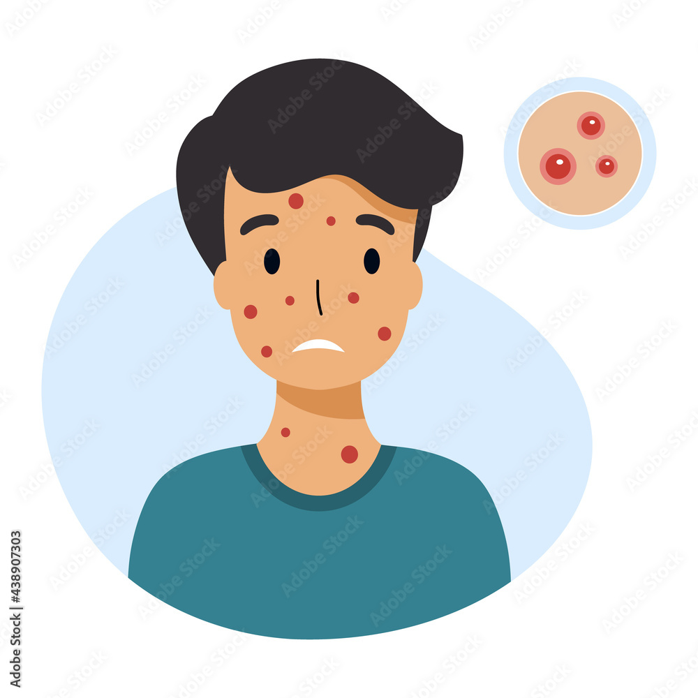 Boy with chickenpox symptoms. Skin rashes and pimples. Vector character ...