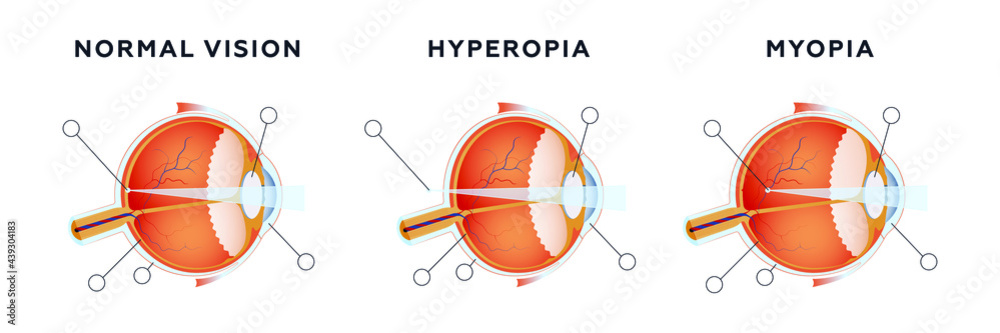 Vision disorders. Normal Vision, Hyperopia, Myopia. Modern Flat Vector ...