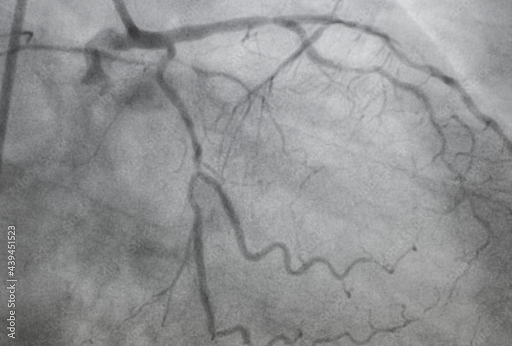 Coronary angiography, Coronary artery disease. Medical x-ray of heart ...