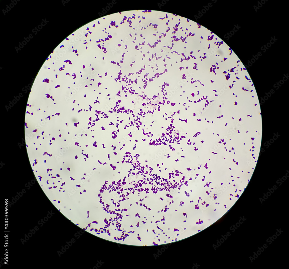 Gram-positive bacteria Streptococcus pyogenes which cause Scarlet fever ...