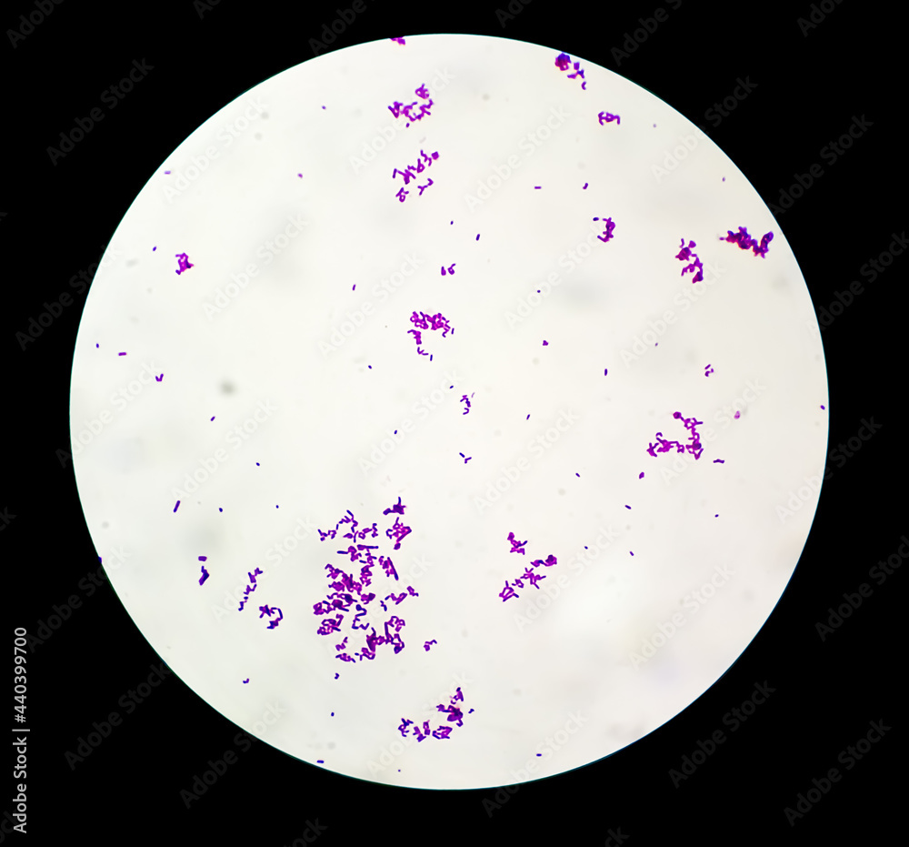 Gram-positive bacteria Streptococcus pyogenes which cause Scarlet fever ...